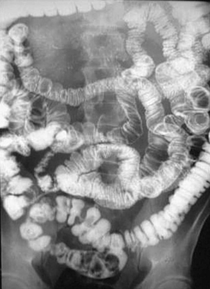 Estudios Contrastados del Sistema Digestivo: Tránsito Del Intestino Delgado