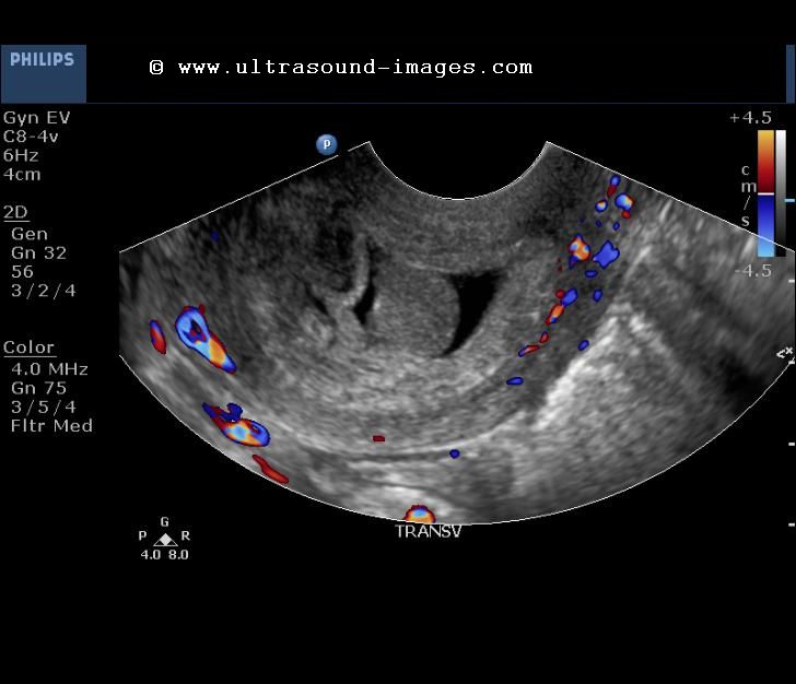 cochinblogs: Sonography in the case of pedunculated polyp