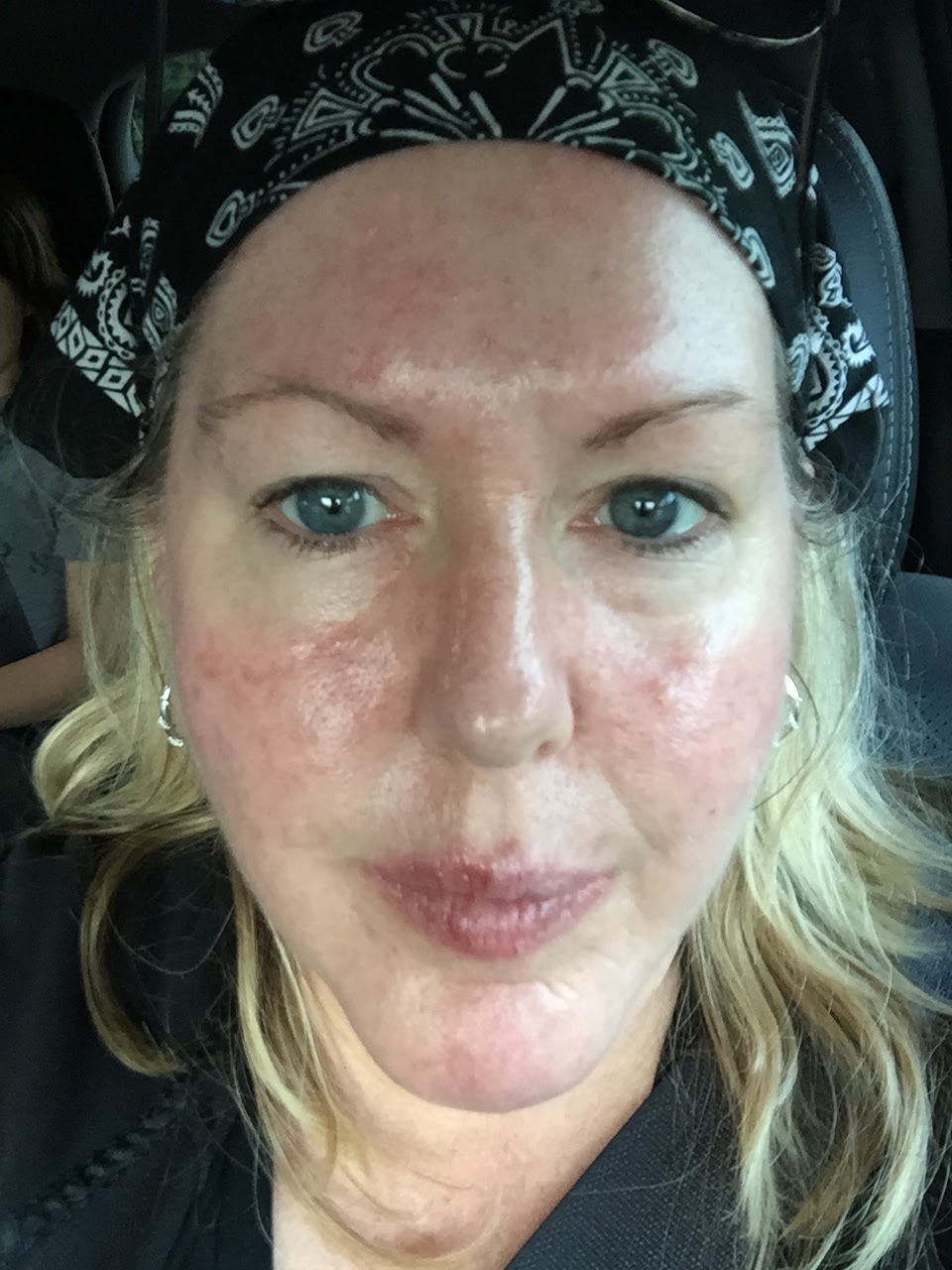 My Journey Through Topical Chemotherapy - Fluorouracil 5% Cream and ...