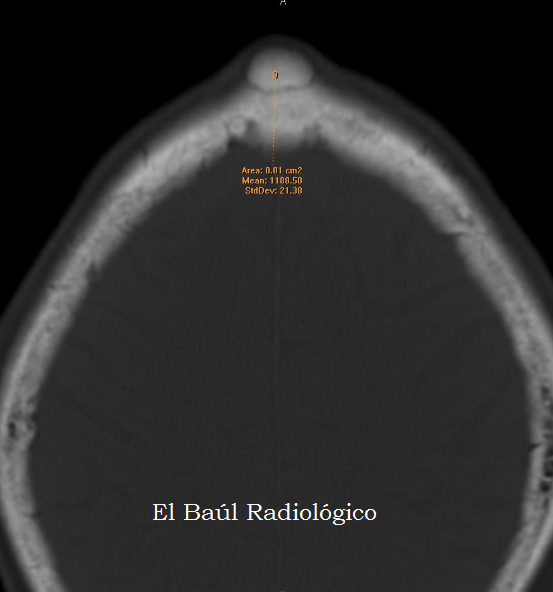 El Baúl Radiológico: OSTEOMAS CRANEALES. (Cranial Osteomas. CT Findings ...