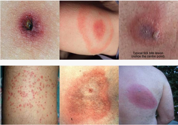 Mad Moose Mama: Black~Legged Ticks in Ontario