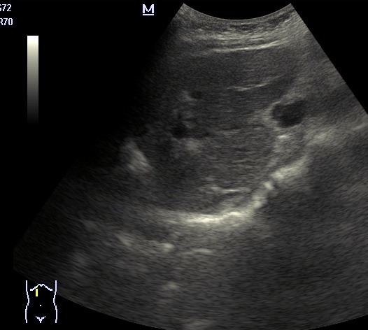 EcoCyl-Grupo: Hepatopatía Crónica