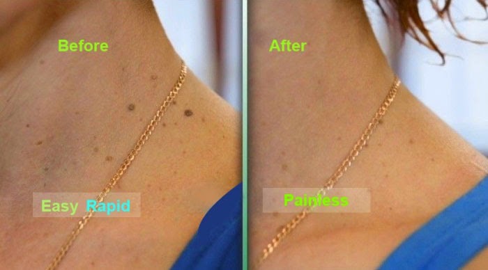 Sani Skin - Shop Online at Best Price in India