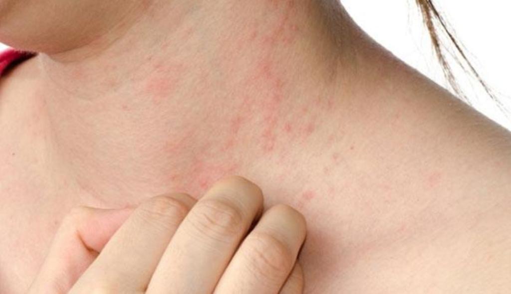 Cara Mengatasi Keringat Buntet / Biang Keringat - Rairaka Herbal