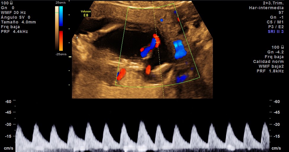 Edufetus: Doppler Pulsado: Velocidad de barrido. ¿Por que es importante?