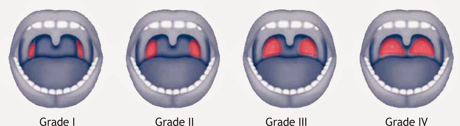 Tonsil Grading Chart