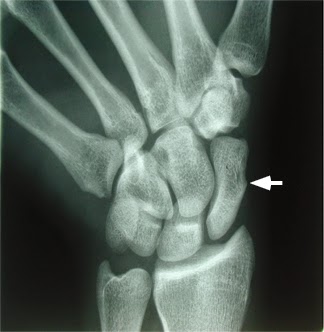 DE GUARDIA EN URGENCIAS: Fractura de Escafoides