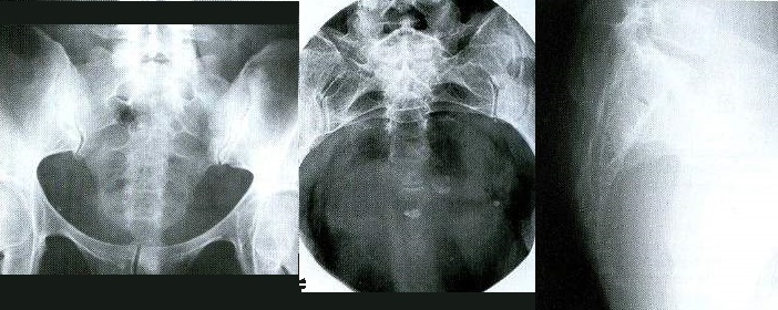 Estudo Radiográfico : ROTINA DE SACRO E CÓCCIX