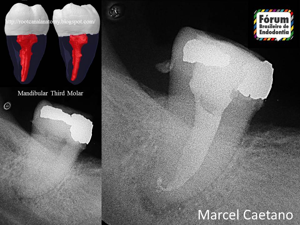 Endodontia Avançada: Anatomia de um Terceiro Molar Inferior