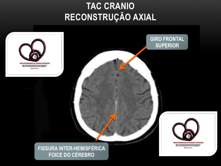 Viver Enfermagem em Cuidados Intensivos: TAC DE CRANIO... VISUALIZANDO ...