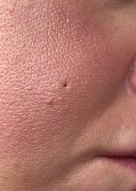 Scars Skin Care - Mission Flawless