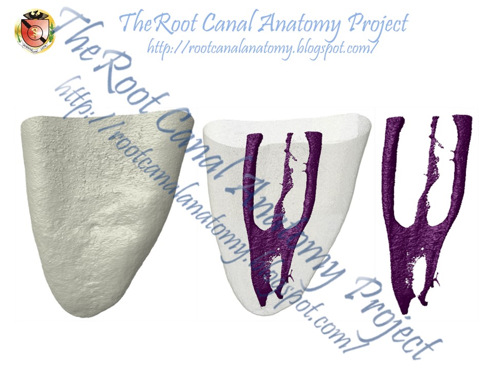 The Root Canal Anatomy Project: Middle Mesial Canal - Mandibular Molar