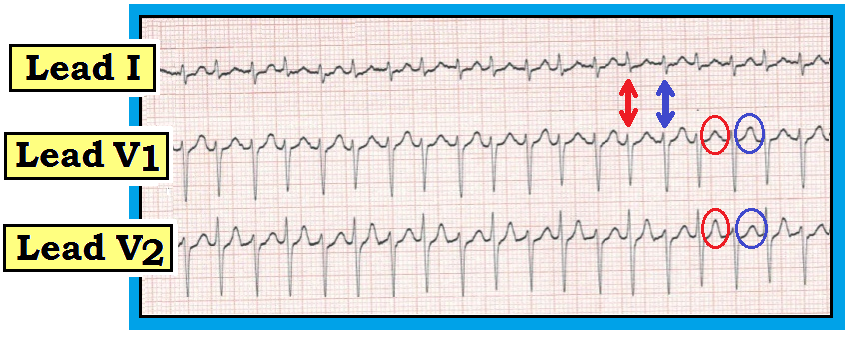 ECG Interpretation: ECG Interpretation Review #83 (PSVT – AVNRT – AVRT ...