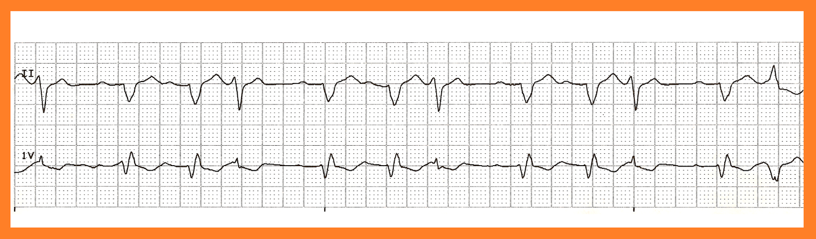 Practice EKG Strips 329