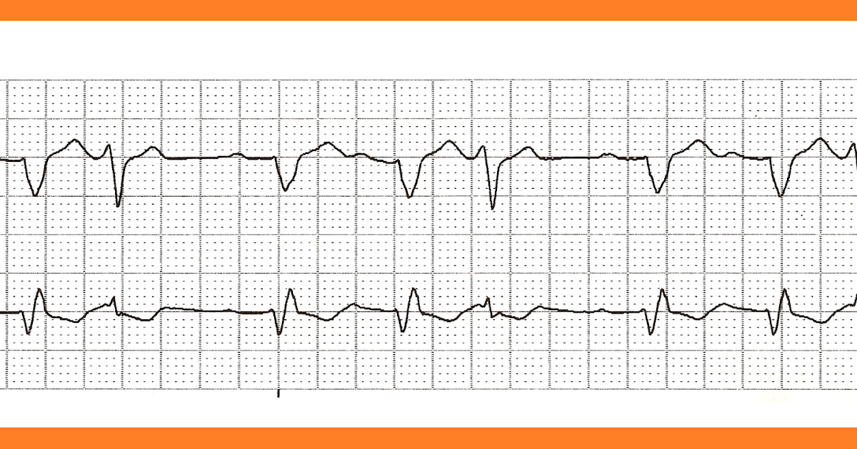 Float Nurse: Practice EKG Strips 329