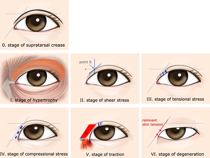 Teuim Aesthetic Plastic Surgical Clinic Dr.Kwon: What is the epicanthus?