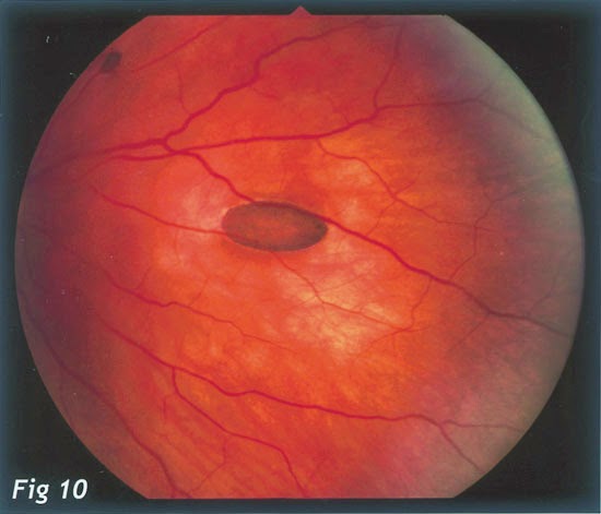 Retinal Photography Review: CHRPE - Eyedolatry