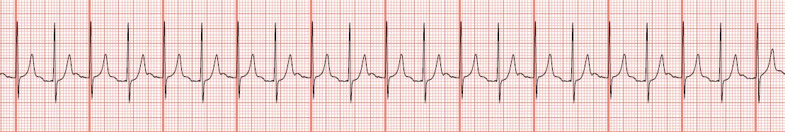 ECG Rhythm Strips 82: Hyperkalemia