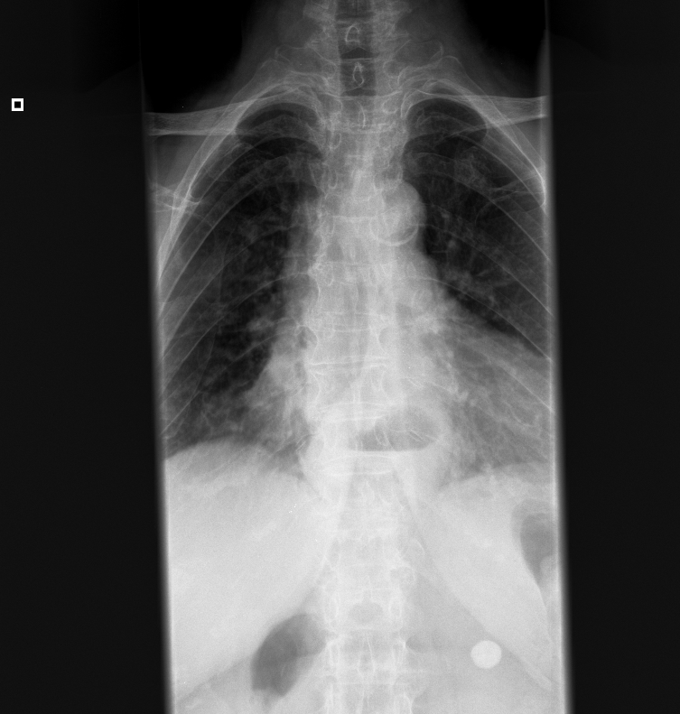 El Blog de Isa y Juan: Imagen radiográfica de la hernia de hiato