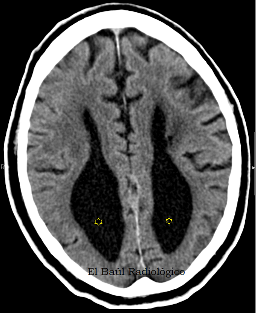 El Baúl Radiológico: AGENESIA DEL CUERPO CALLOSO: HALLAZGOS EN TC e IRM ...
