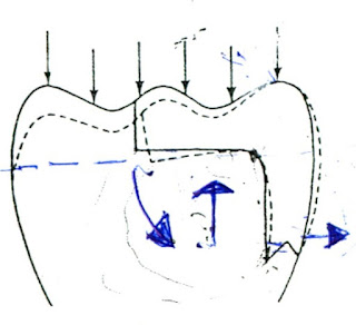 Dental Dreamz: Forces Acting on Restorations- A Seminar