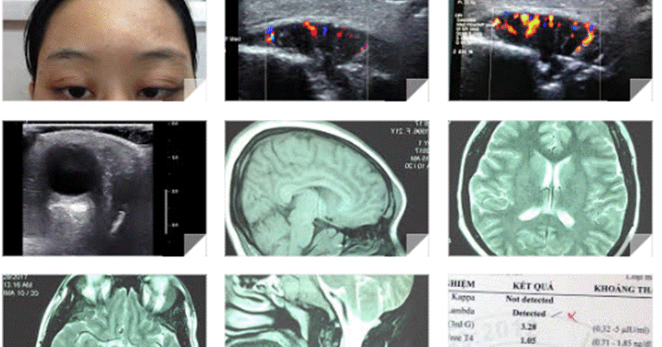 VIETNAMESE MEDIC ULTRASOUND: CASE 425: FRONTAL BONE TUMOR, Dr PHAN ...