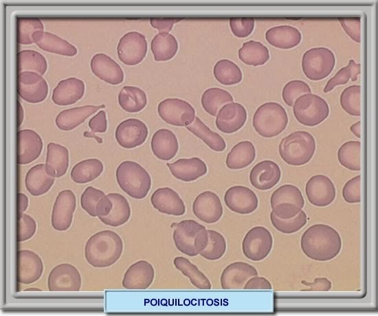fichero hematologia: poiquilocitosis