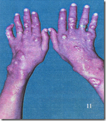 Alerta Hanseniase: Tipos de Hanseniase