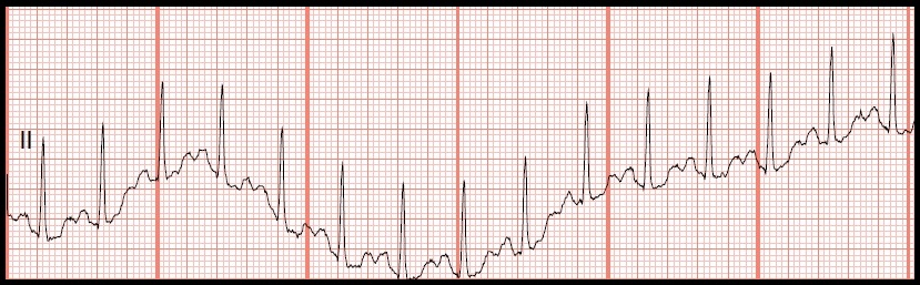 Float Nurse: Practice EKG Rhythm Strips 124