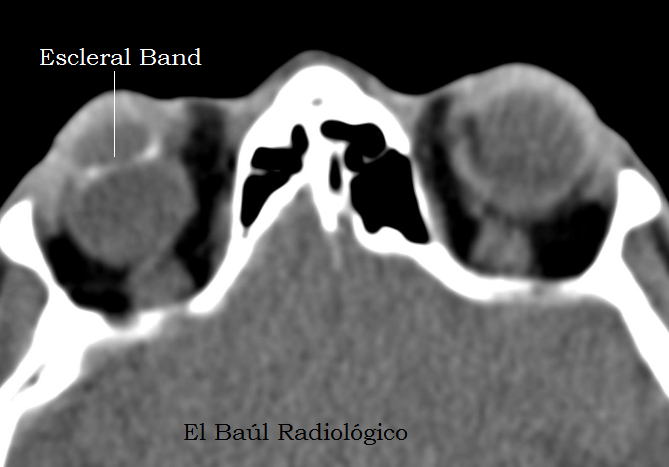 El Baúl Radiológico: BANDA ESCLERAL DE SILICONA: HALLAZGOS EN ...