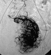 Medical Treatment Pictures-for Better Understanding: Uterine Fibroid ...