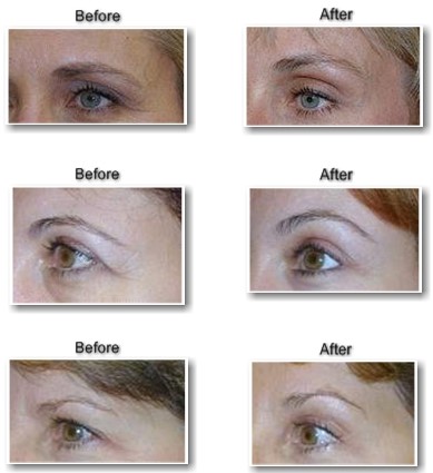 Selston Cosmetic Clinic: Make Your Face Look Younger With A Botox Brow ...