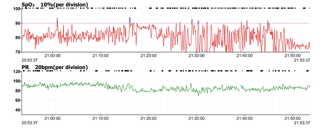 Sleep apnea : SPO2 @ 12000 feet elevation