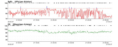 Sleep apnea : SPO2 @ 12000 feet elevation