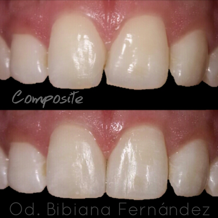 ODONTOESTETICA A TU ALCANCE: RESINAS COMPUESTAS. Caso Clínico