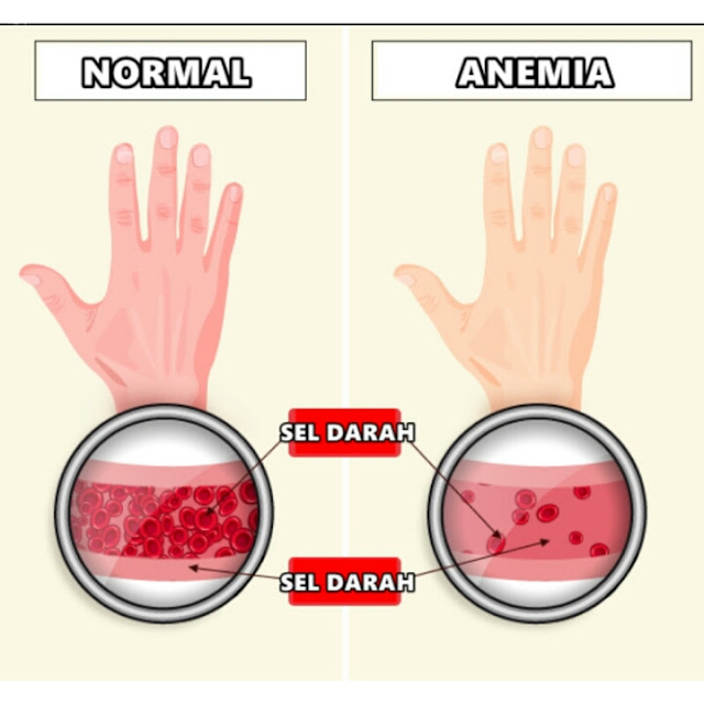 KENALI ANEMIA DAN CARA MENGATASINYA