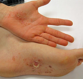 Dyshidrotic Eczema Natural Treatment | Dyshidrotic Eczema Treatment
