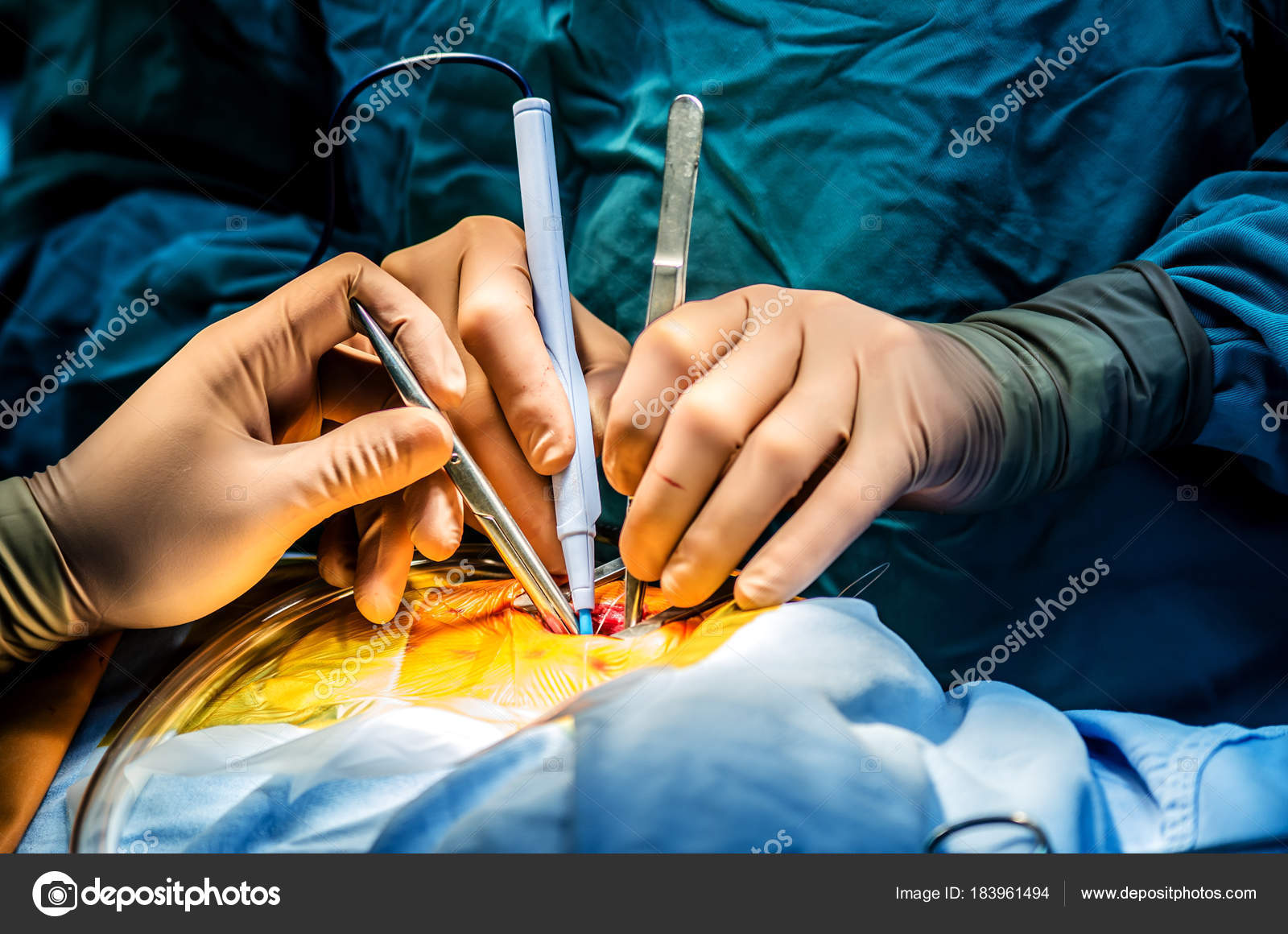 Técnicas Quirúrgicas : Electrocirugía,un método eficaz pero riesgoso