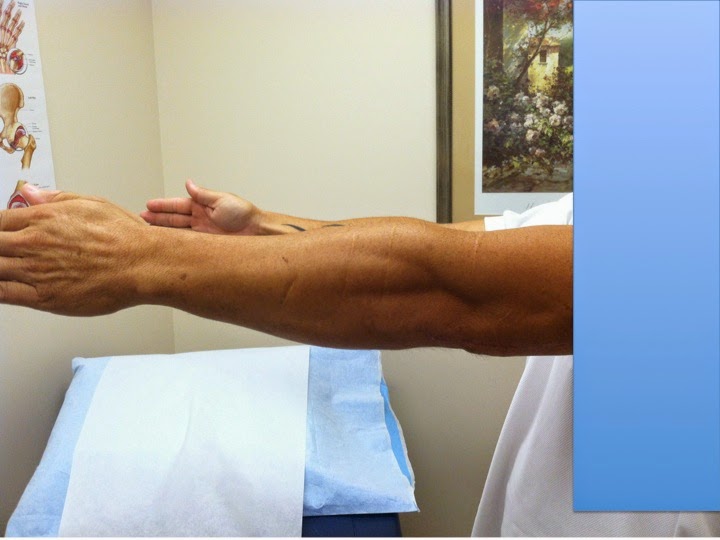 Shoulder and Elbow Surgery: Distal triceps ruptures in athletes ...