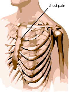 Precordial catch syndrome - Texidor’s Twinge - Remedy Land