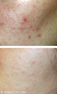 How to fade red acne marks ?: Best Tips on How to Fade Acne Scars