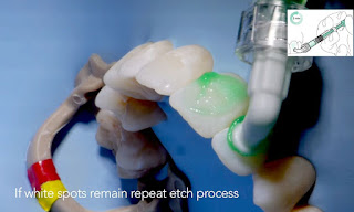 STEP BY STEP: Fluorosis treatment using ICON infiltration - Odonto-Tv