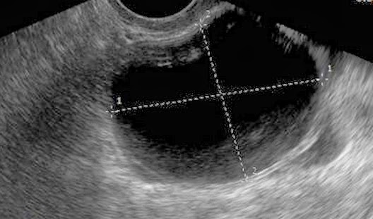 Klinik Dr Zaharuddin KL Gynaecologist: SISTA OVARI (OVARIAN CYST)