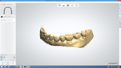 Drなるとのブログ: フルジルコニアクラウンの制作過程 FCZ Crown: Full Contour Zirconia Crown ,KATANA