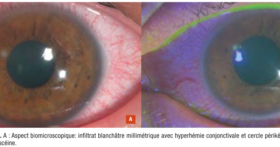 Oeil rouge et/ou douloureux - Documents de Médecine