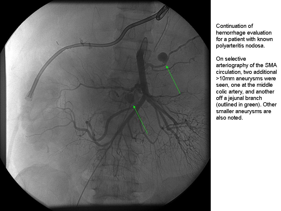 The Pump and the Tubes: The Vasculitides: Polyarteritis Nodosa