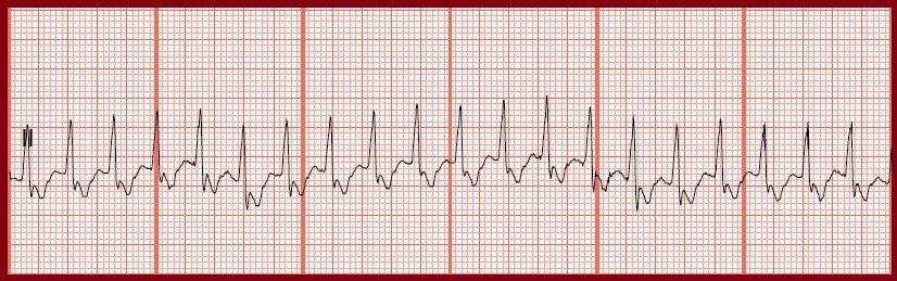 Practice EKG Rhythm Strips 222