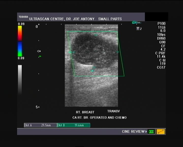 Ultrasound imaging: Seroma following lumpectomy in breast cancer: