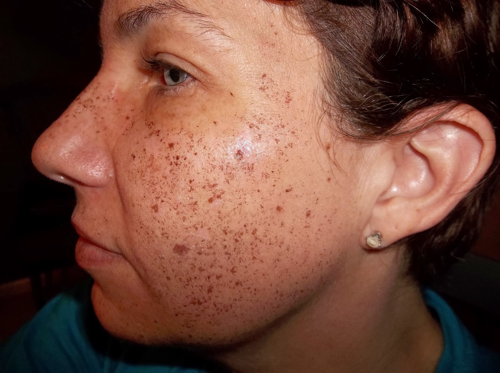 Why Not Start Today: Intense Pulsed Light (IPL) Treatment