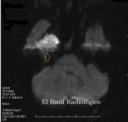 El Baúl Radiológico: 2) QUISTE DERMOIDE INTRACRANEAL (Intracranial ...